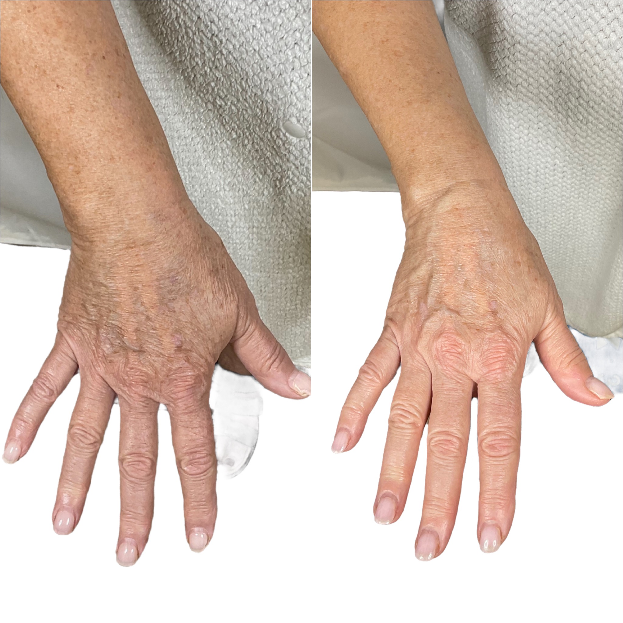 Hand Rejuvenation in Lee's Summit - Dr. Chow's Rejuvenation Practice Medspa