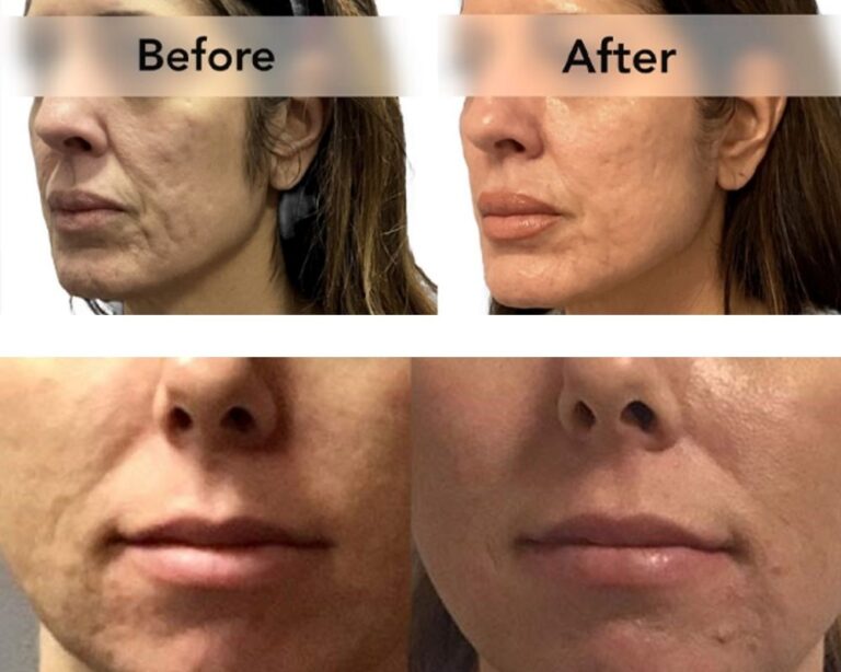 Acne Scar Treatment in Kansas City - Dr. Chow's Rejuvenation Practice ...