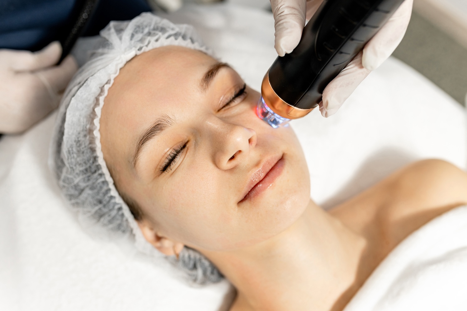 Vivace Ultra RF Microneedling – Winter Collagen Treatment